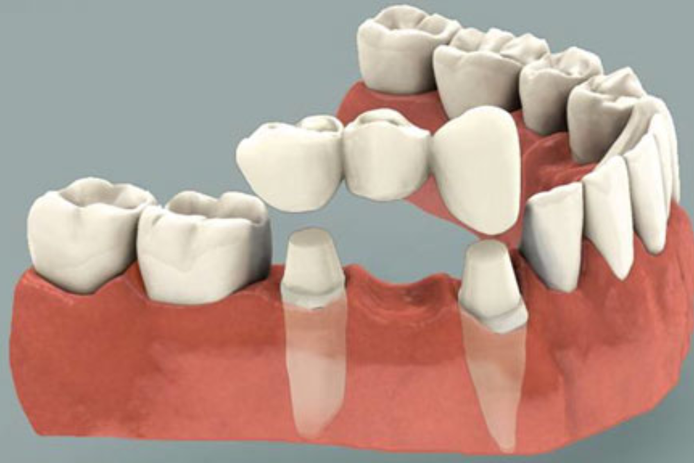 What is a Dental Bridge and How Does it Work? - MC Dental